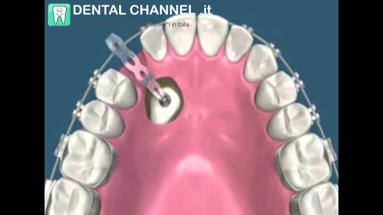 Canino incluso trattato con l'Ortodonzia - DENTAL CHANNEL .it - YouTube