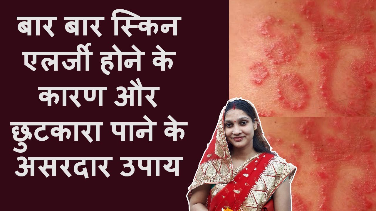 चर्म रोग, स्किन एलर्जी होने के कारण लक्षण और छुटकारा पाने के अचूक उपाय ...