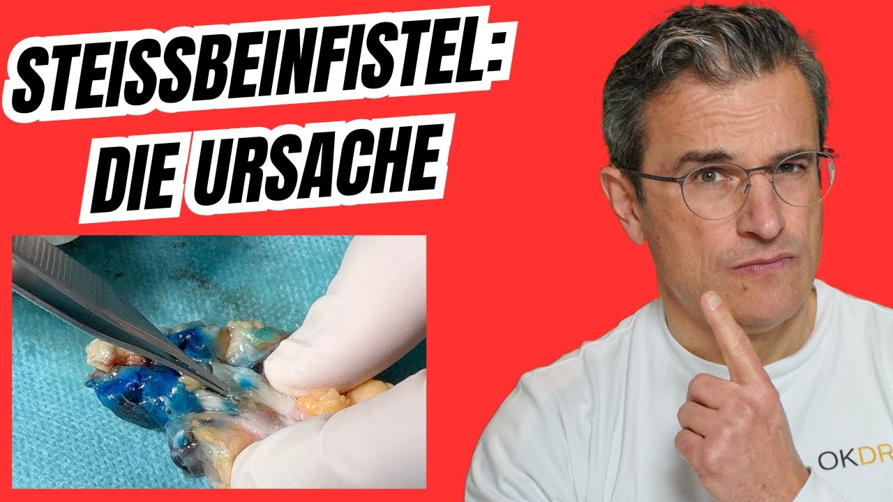 🔬 Steißbeinfistel: So sieht die Entzündung von innen aus! 🩺 Dr. med ...