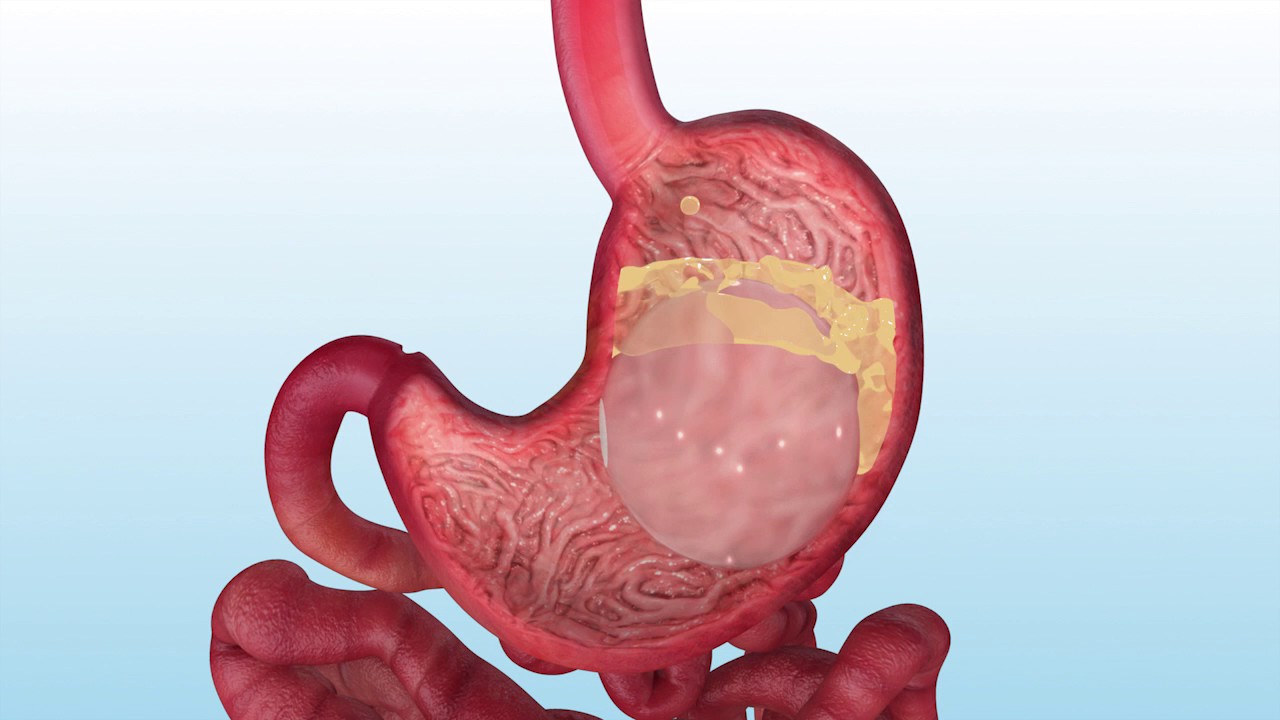 Orbera™ Gastric Balloon - YouTube