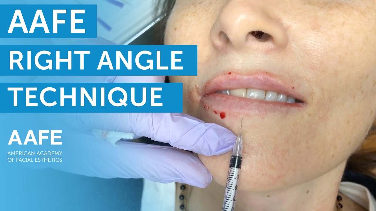 The AAFE Right Angle Technique | AAFE - YouTube