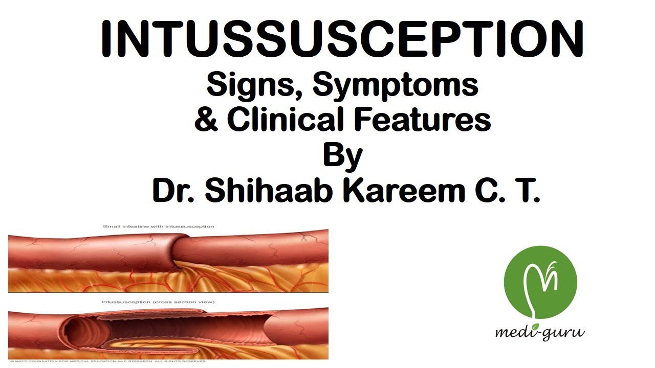 Intussusception | Clinical Peadiatrics Series 01 | Dr. Shijab ...