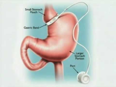 Gastric Bypass Surgery & Lap-Band Surgery Chicago - How It Works - YouTube