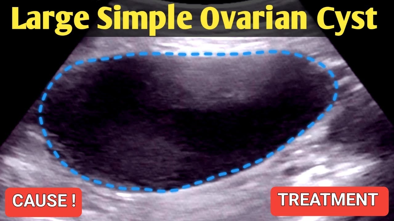 Large Simple Ovarian Cyst Ultrasound YouTube