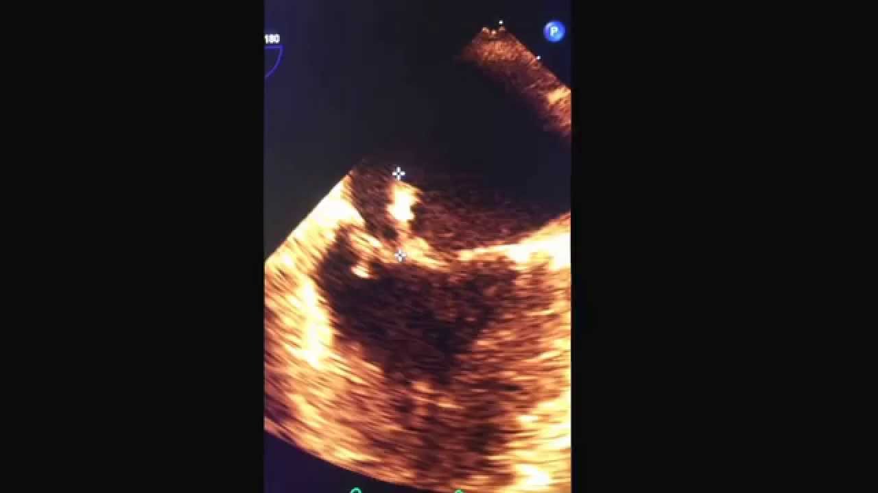 Mitral perforation endocarditis TEE - YouTube
