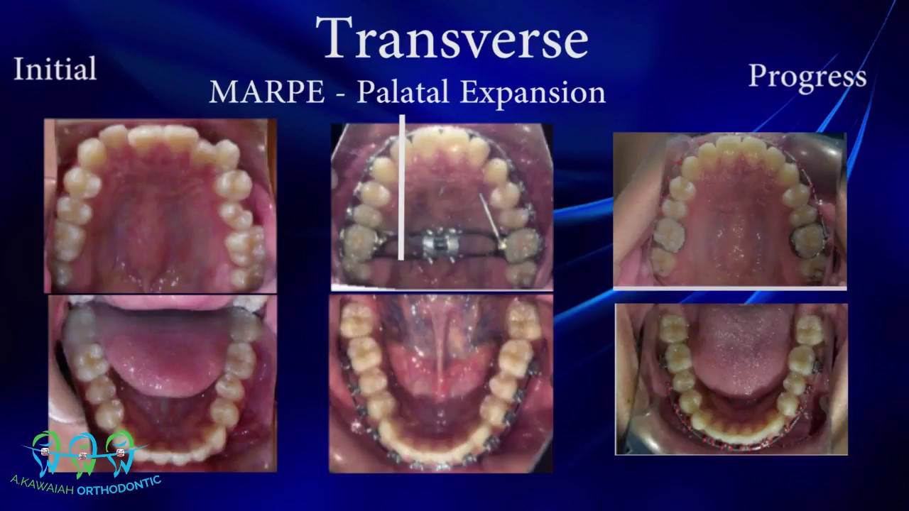 Palatal Expansion - Correct jaw misalignment without surgery - YouTube