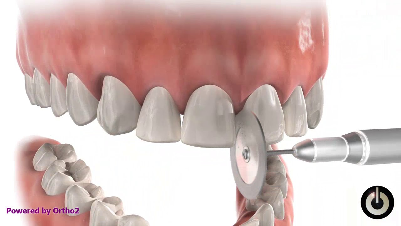 Tx IPR Reduce DBT - YouTube