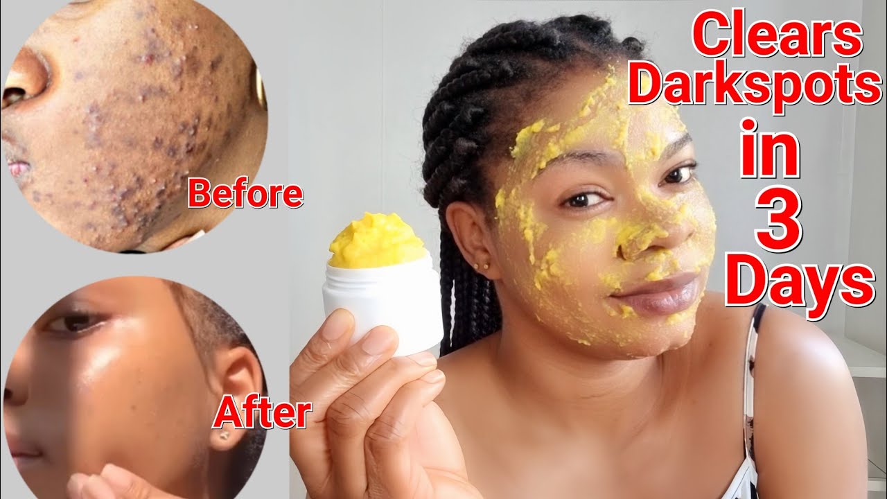 How to Clear acnes and Darkspots in 3 days using this orange mask works ...