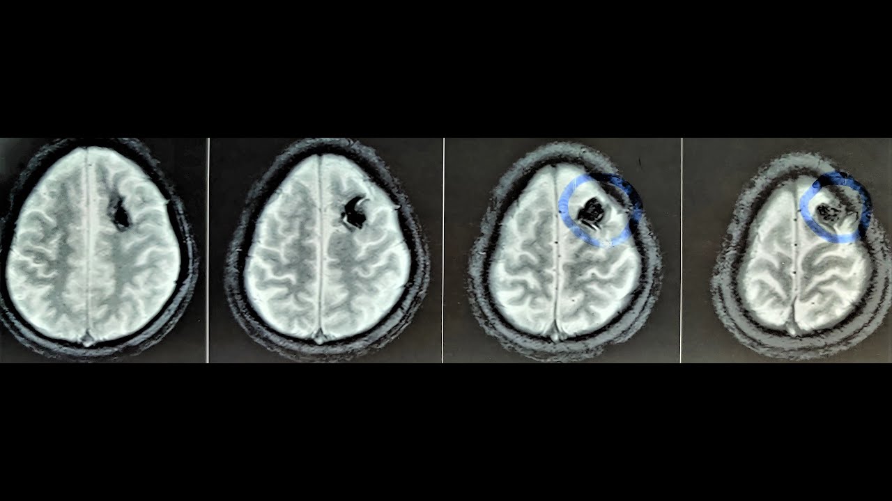 EPILEPSY SURGERY-CAVERNOUS ANGIOMA LT FRONTAL-NAVIGATION GUIDED ...