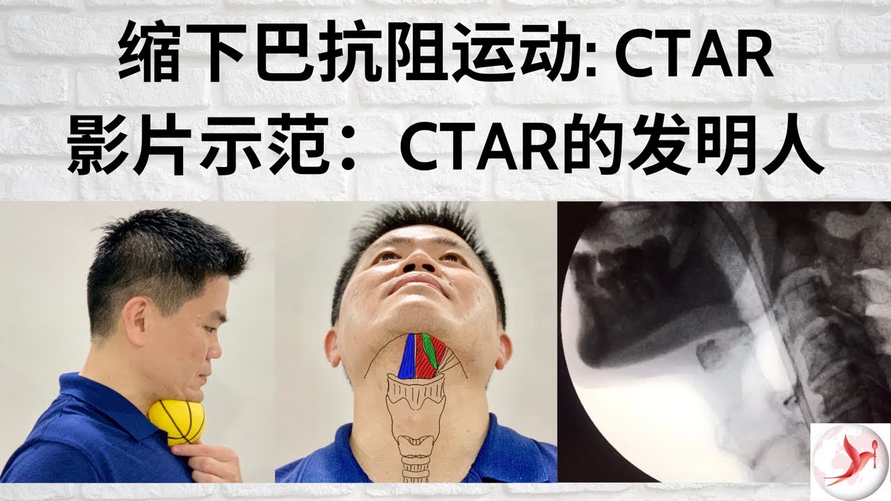 (Mandarin) Dysphagia Swallowing Exercise - Chin Tuck Against Resistance ...
