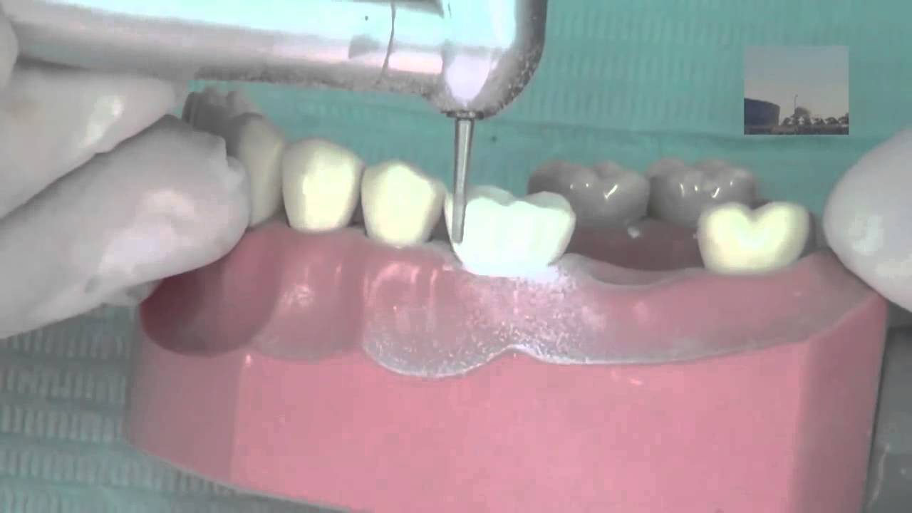 Full metal crown preparation for dental students - YouTube