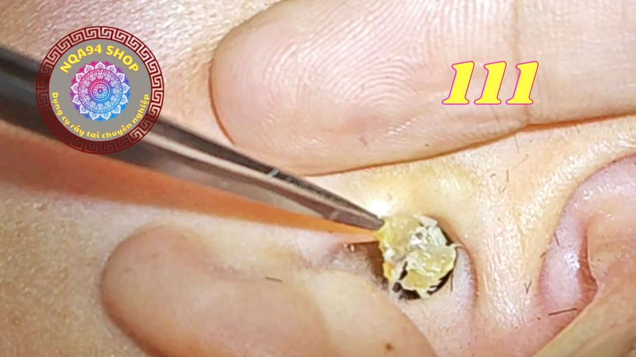 Tập 111. Lấy ráy tai không khó. Removing earwax is not difficult. # ...