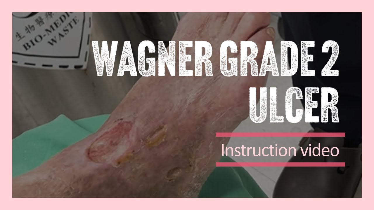 Wagner Grade 2 Ulcer - YouTube