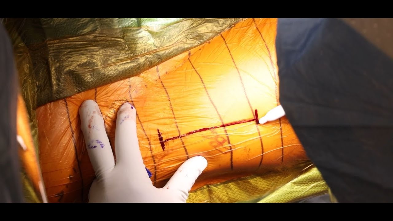 Conversion THA Following Acetabular ORIF - YouTube