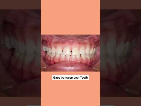 How To Nicely Tell Someone They Need Braces