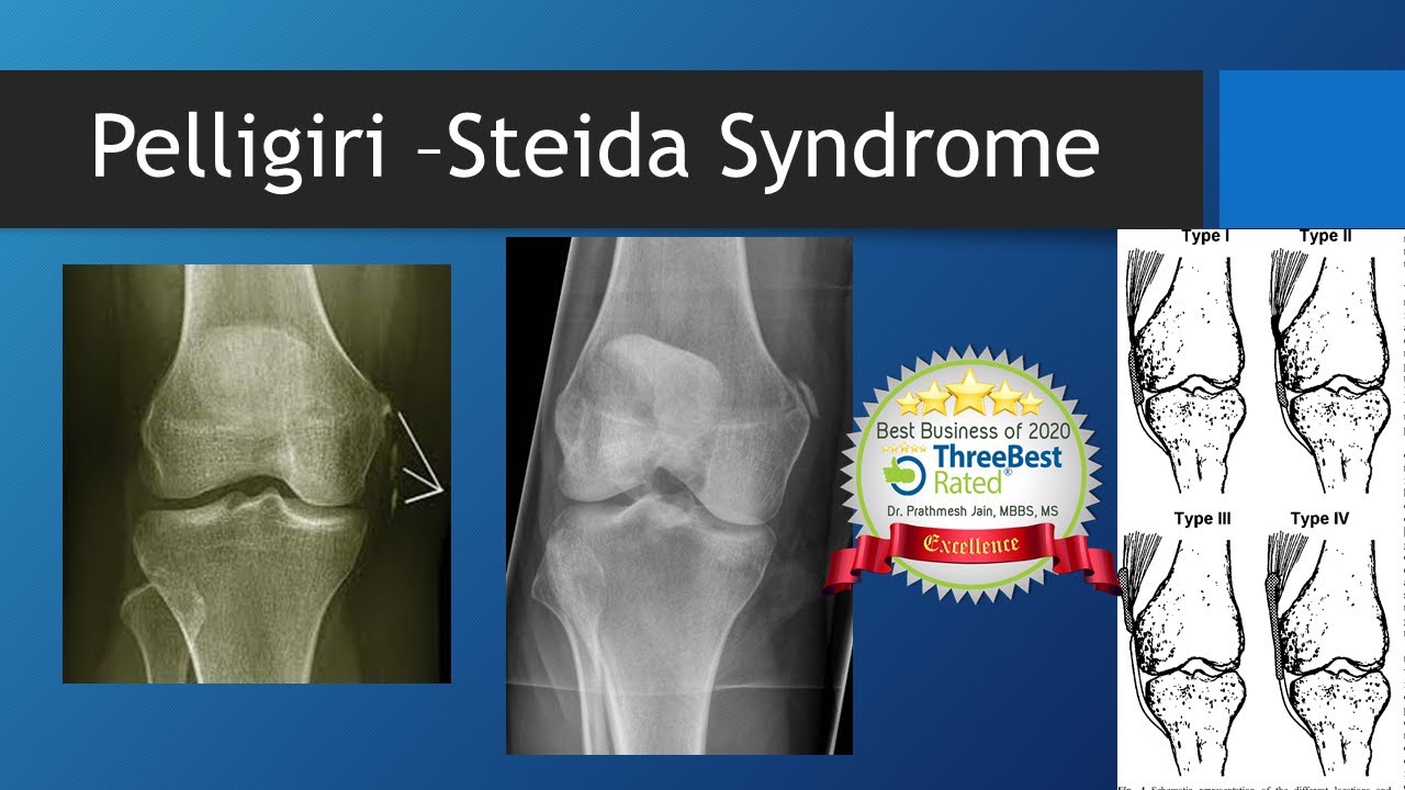 Pelligiri Steida Syndrome(English) - YouTube