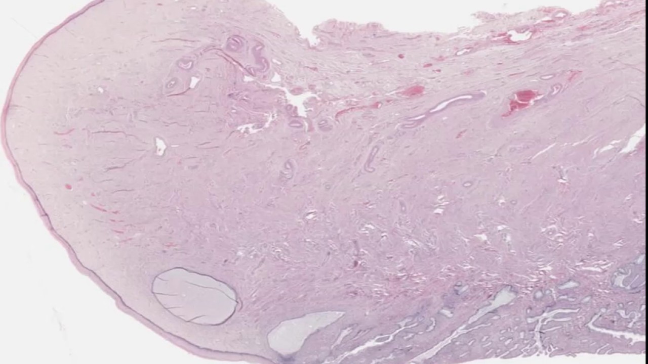 Normal Transformation Zone Histology Cervix Cervix