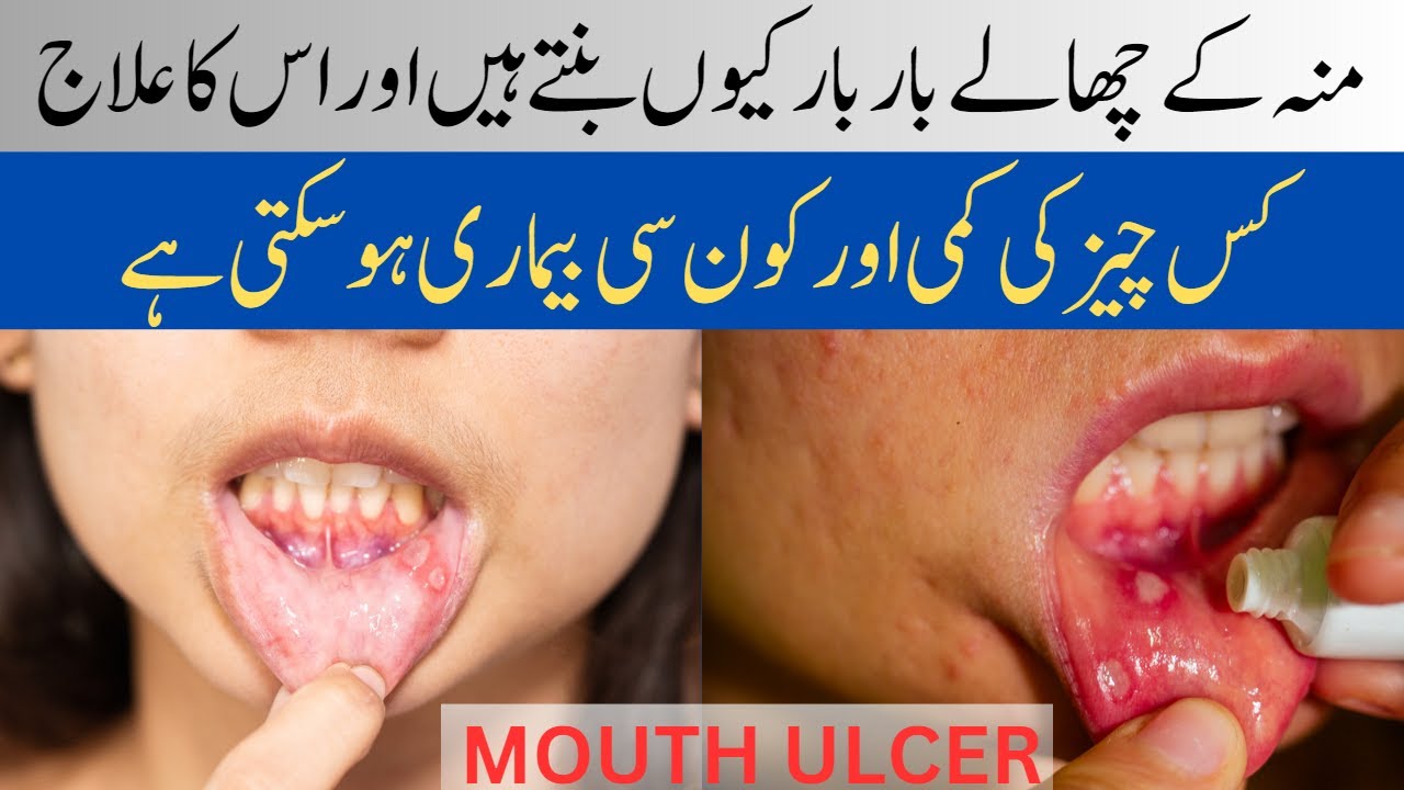 Mouth ulcer Treatment | Mouth ulcer Causes | मुंह के छालें - YouTube