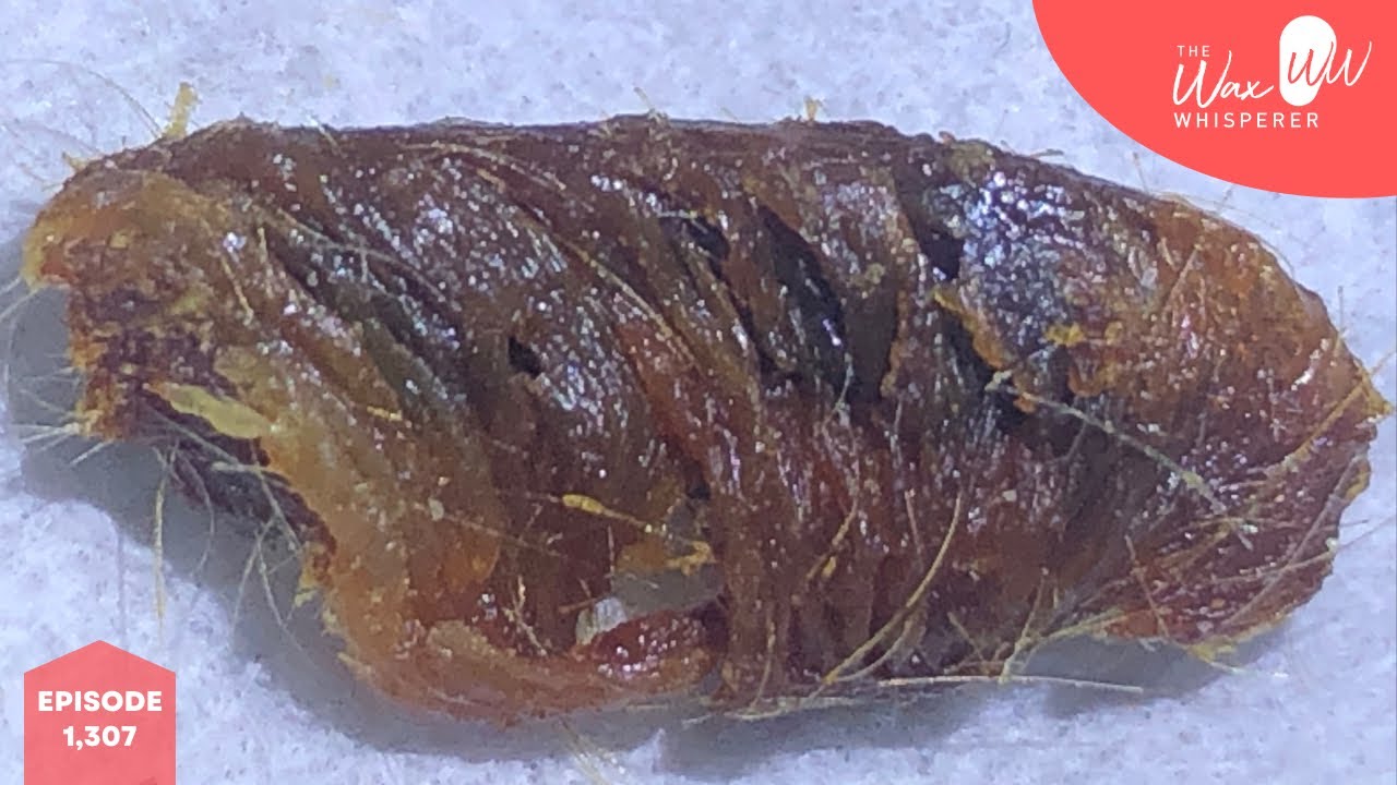 1,307 - Extreme Dead Skin Plug Extraction - YouTube