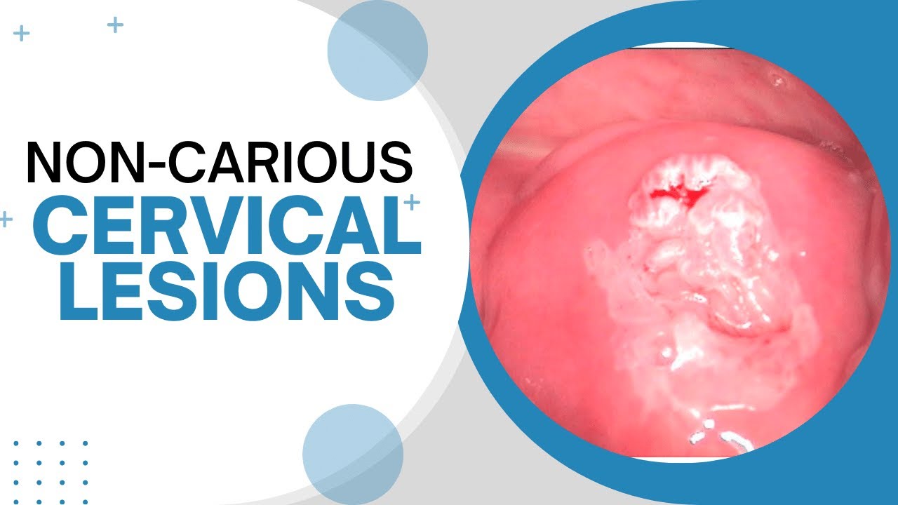 Non-Carious Cervical Lesions: 4 Types You Should Know - YouTube