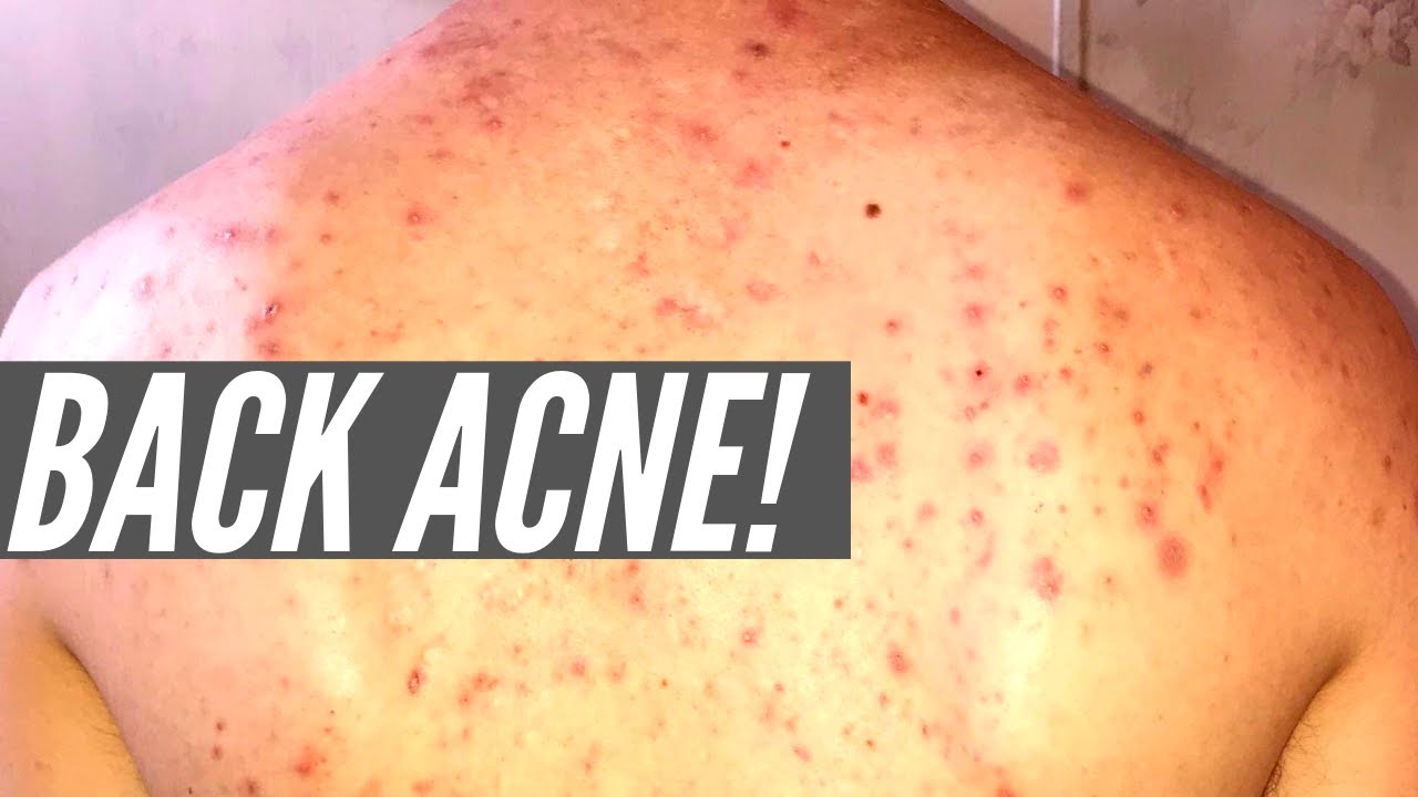 How To Get Rid Of Back Acne Bacne Youtube