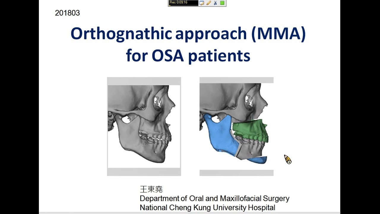 10703【名人講堂】 Orthognathic approach (MMA) for OSA patients 王東堯醫師 - YouTube