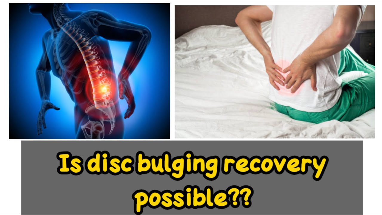 No Surgery | DISC BULGING | recovery story | back to normal life ...