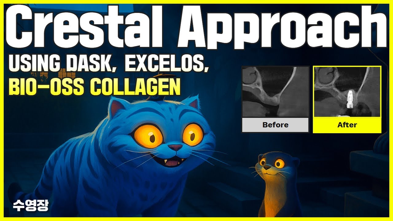 케이팝 데몬헌터스 특집 💕 ️Crestal approach using DASK, Excelos Inject, BioOss ...