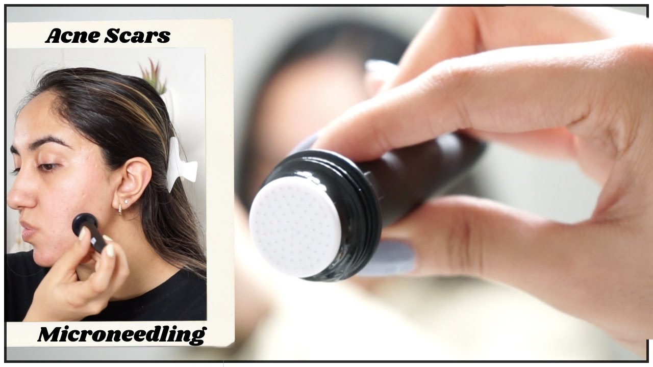 Microneedling at Home: How to use the Banisher 2.0 - YouTube