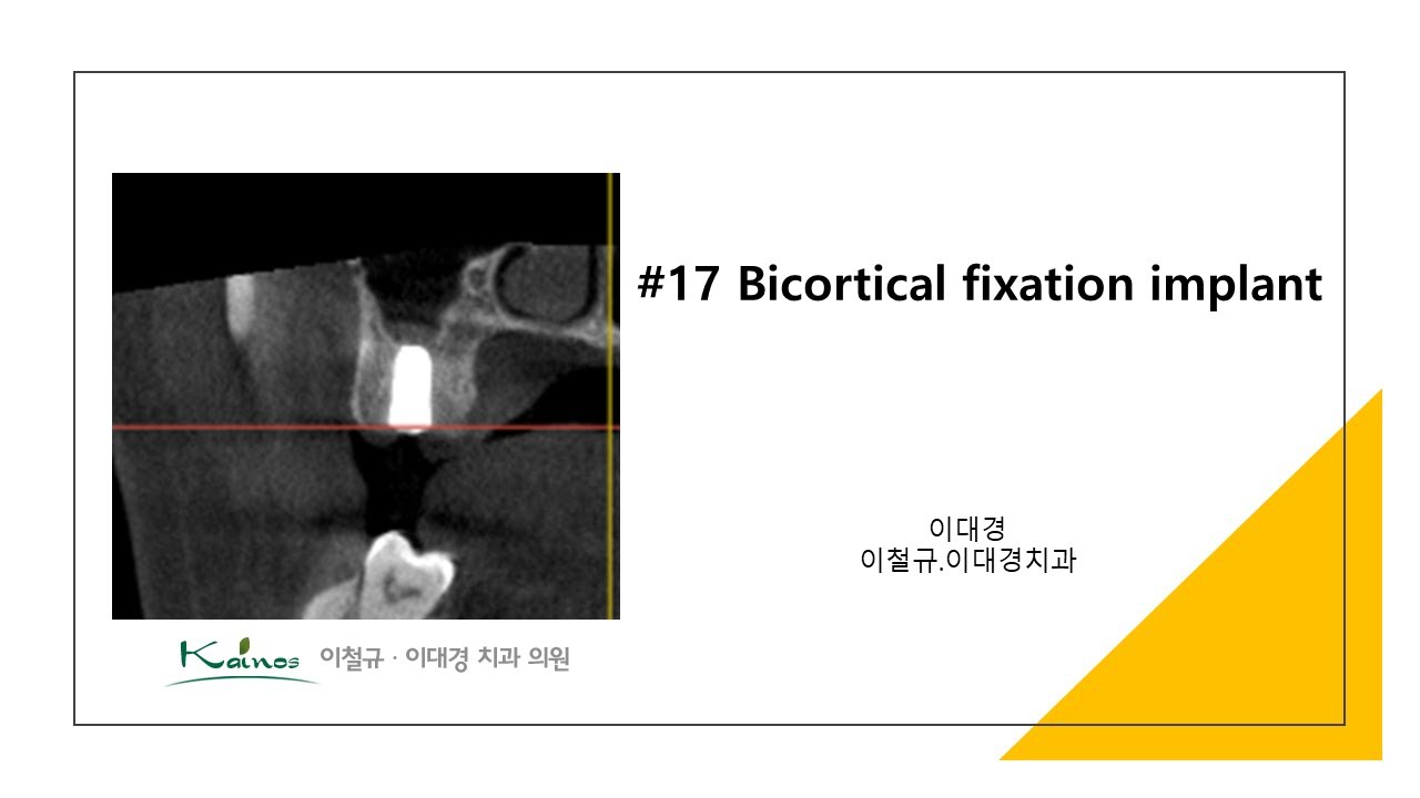 #17 Bicortical fixation implantation - YouTube