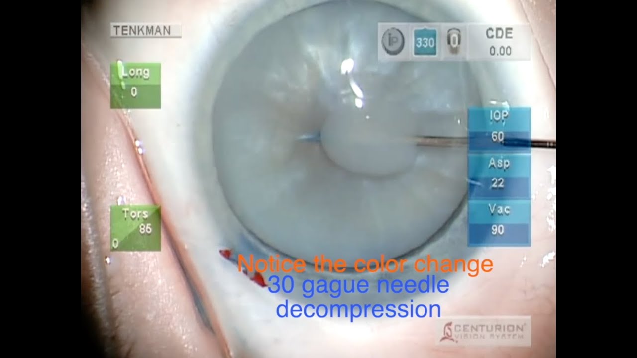 2 - Cataract INTRAOP Lecture 2024 - YouTube