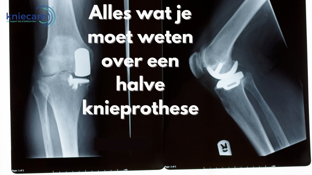 Alles wat je moet weten over een halve knieprothese - YouTube