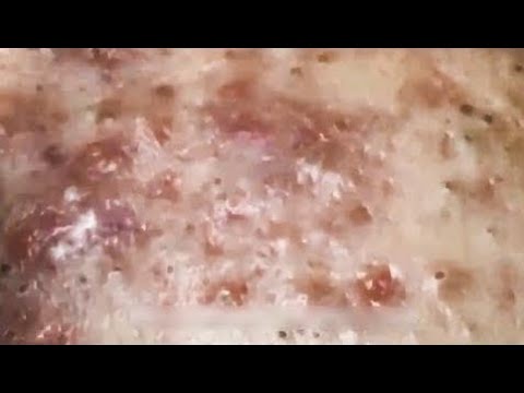 Blackheads 2018 | Blackhead Squeeze, Popping, Pimples Removal - Part 5 ...
