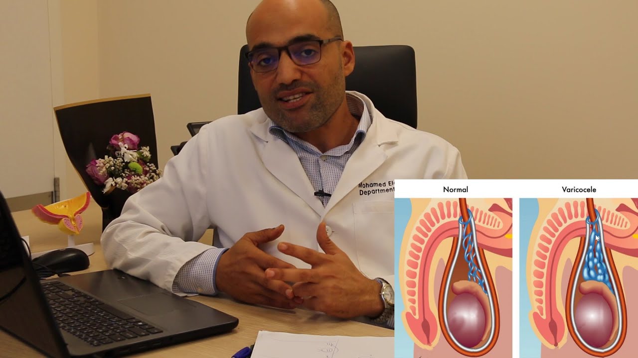 Varicocele: A Simple Lecture for All Patients and All Questions ...