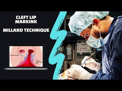 cleft lip marking millard technique رسم تصليح الشفاة المشقوقه بطريقة ...