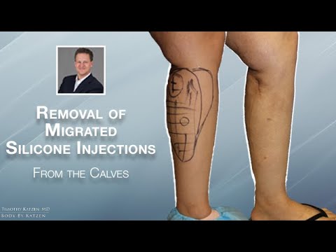 Removal of Illegal Silicone Injections that Migrated to the Calves ...