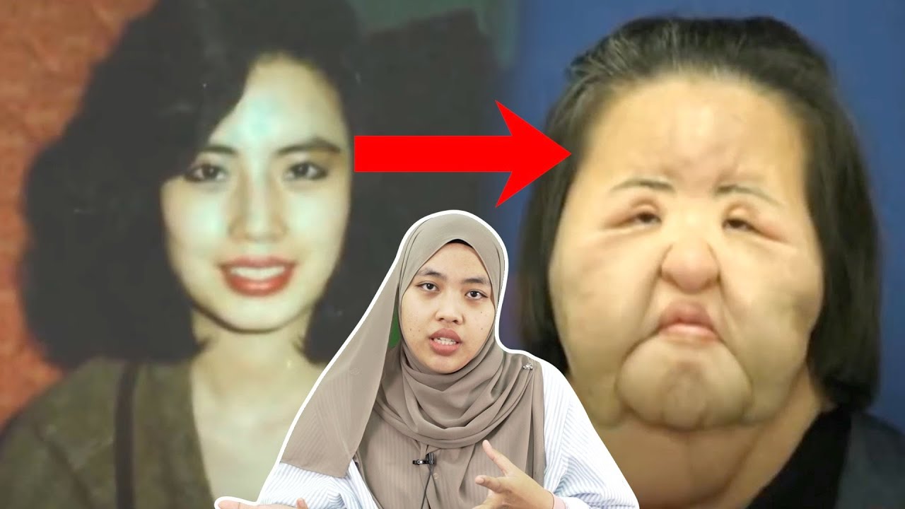 Akibat Ketagih Pembedahan Plastik - YouTube
