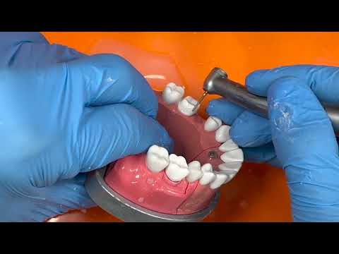 Adex metal prep for bridge tooth #3 - YouTube