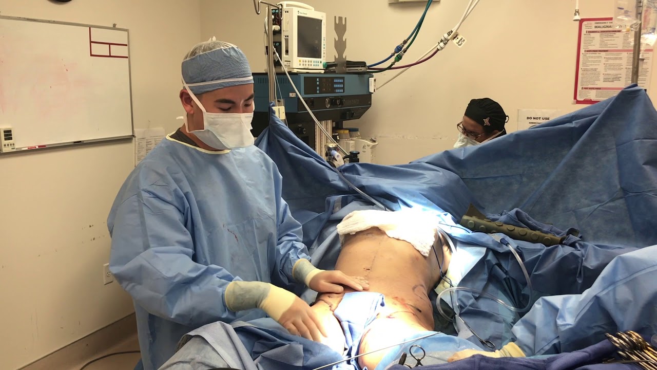 Mommy Makeover (Breast Aug, Thigh lift, Tummy Tuck) - Dr. Johnson C ...