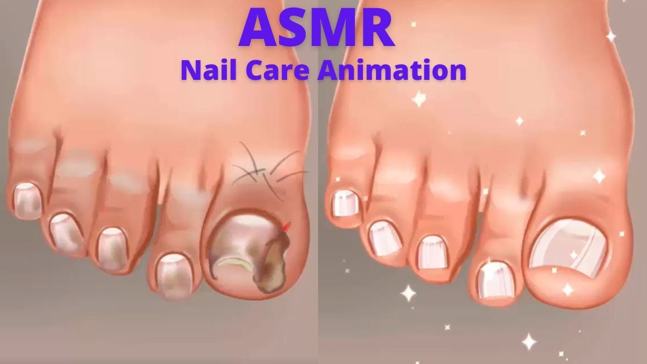 ASMR Nail Care Animation | Satisfying ASMR Ingrown Toenail Removal ...