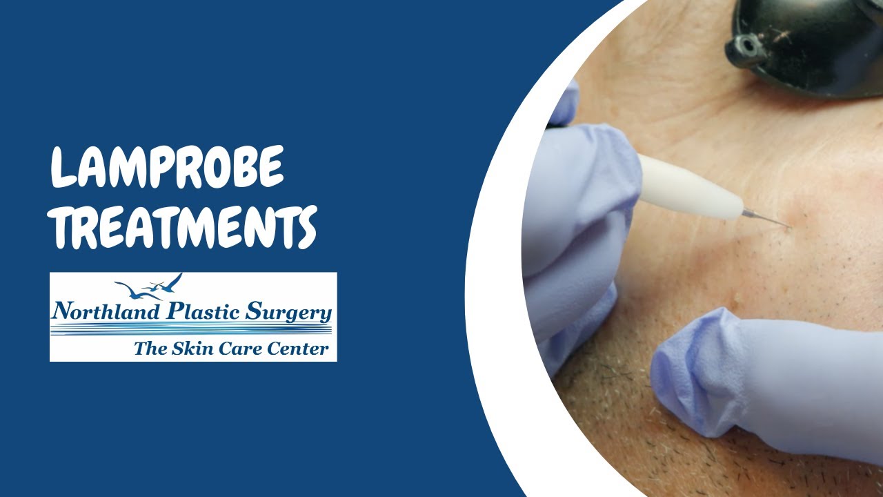 Lamprobe Treatments | The Skin Care Center | Northland Plastic Surgery ...