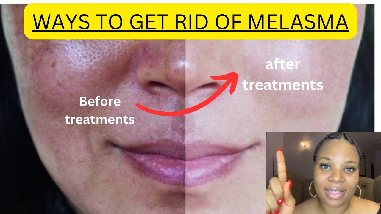 HOW TO GET RID OF MELASMA (quick and easy methods) - YouTube