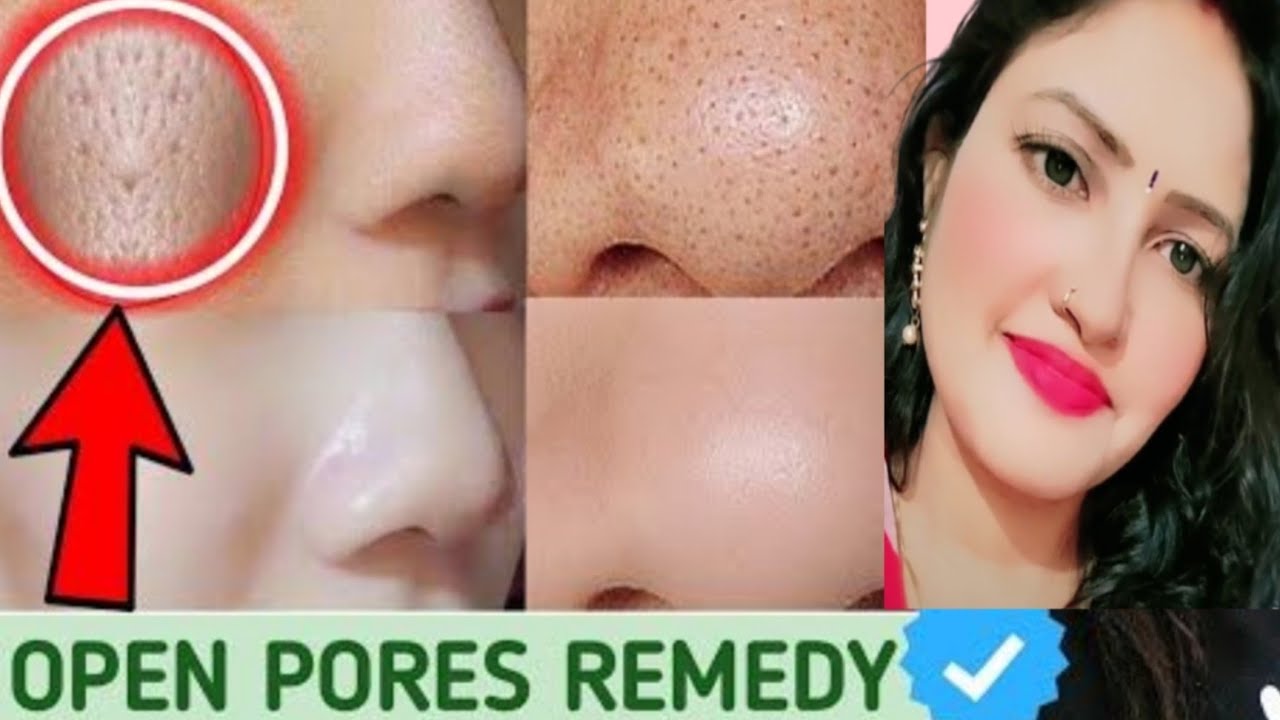 How To Get Rid of OPEN PORES, LARGE PORES, CLOGGED PORES (Permanent ...