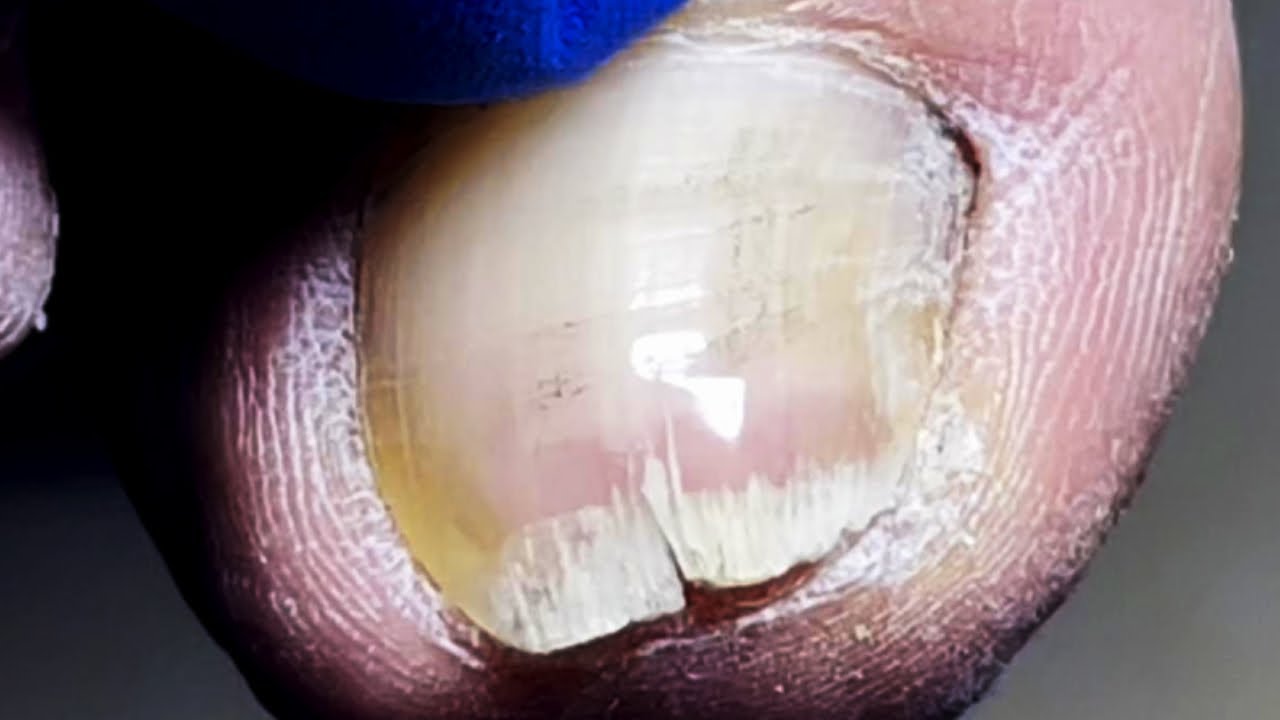 Cut Off Excess Nails Silkily And Very Dry~ #Pedicure - YouTube