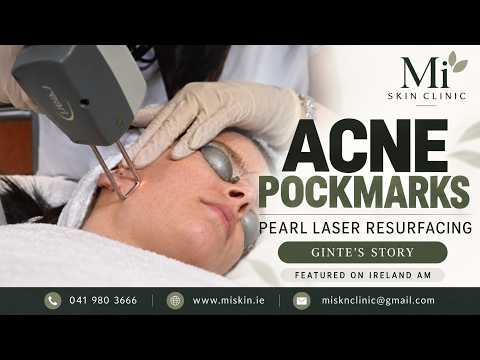 Pearl Laser- Acne Pock marks