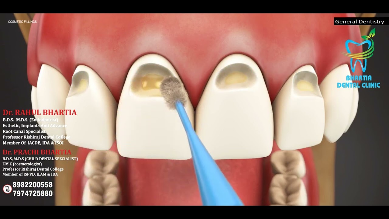 Seamless Smiles: The Art of Bonded Fillings - YouTube