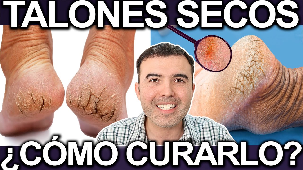 COMO CURAR LOS TALONES SECOS Y AGRIETADOS - Regenera La Piel De Tu ...
