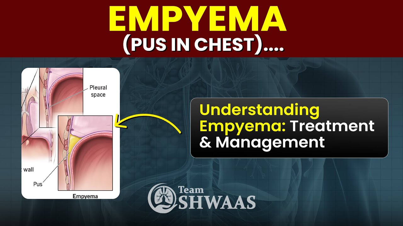 Understanding Empyema: Treatment & Management - YouTube