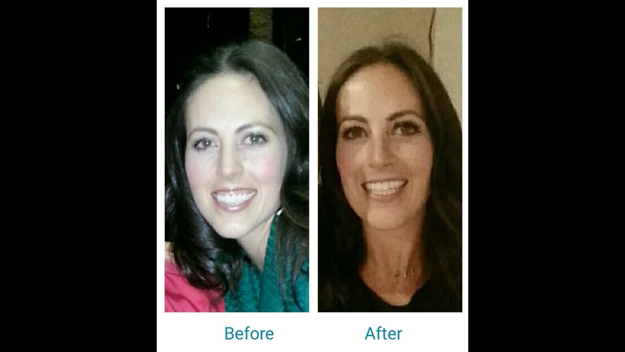 Jaw Surgery Update: One Year Post Op (with Before/After Photos!) - YouTube