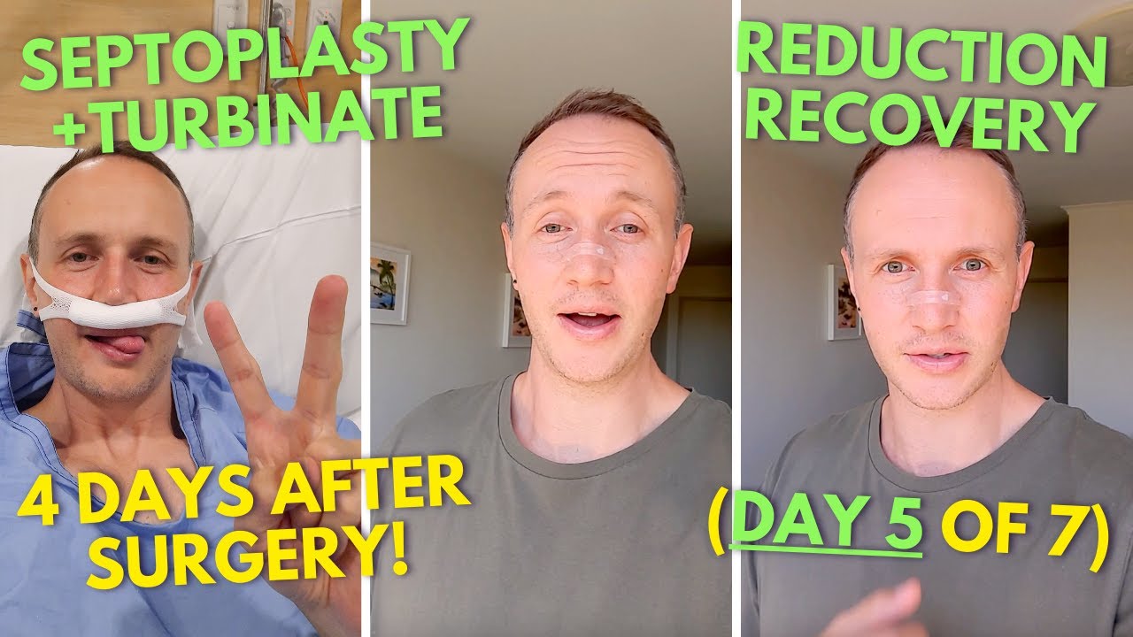 My Septoplasty + Turbinate Reduction Surgery Recovery - (Day 5 of 7) Day By Day Vlog - YouTube
